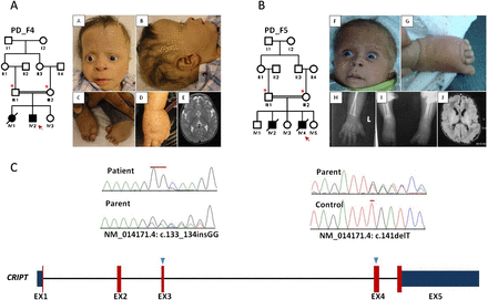 Genomic analysis of primordial dwarfism reveals novel disease genes